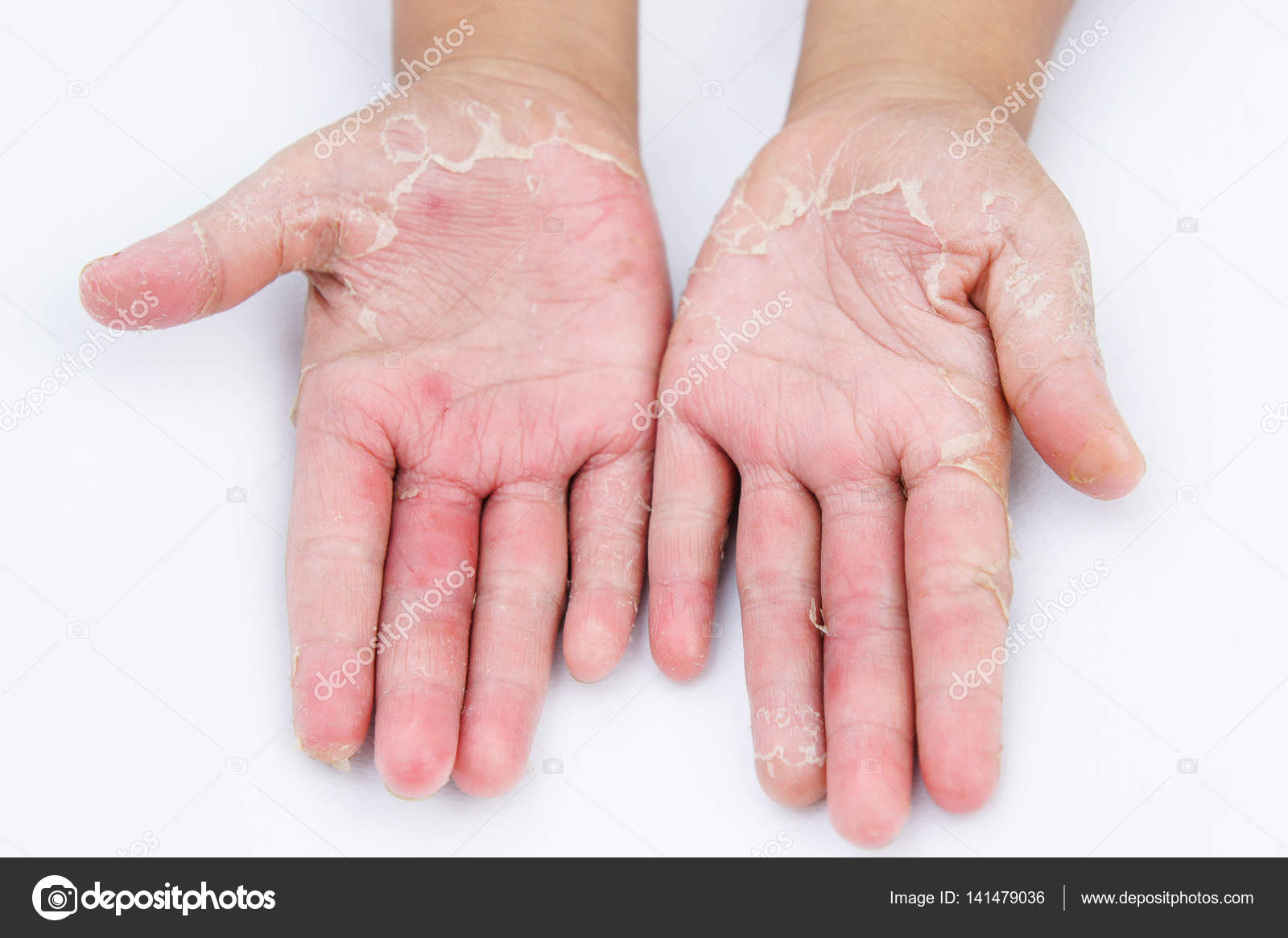 Dry hands, peel, Contact dermatitis, fungal infections, Skin inf Stock ...