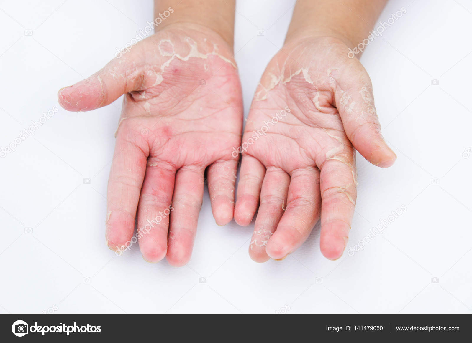 Mains Sèches Peau Dermatite Contact Infections Fongiques Infections ...