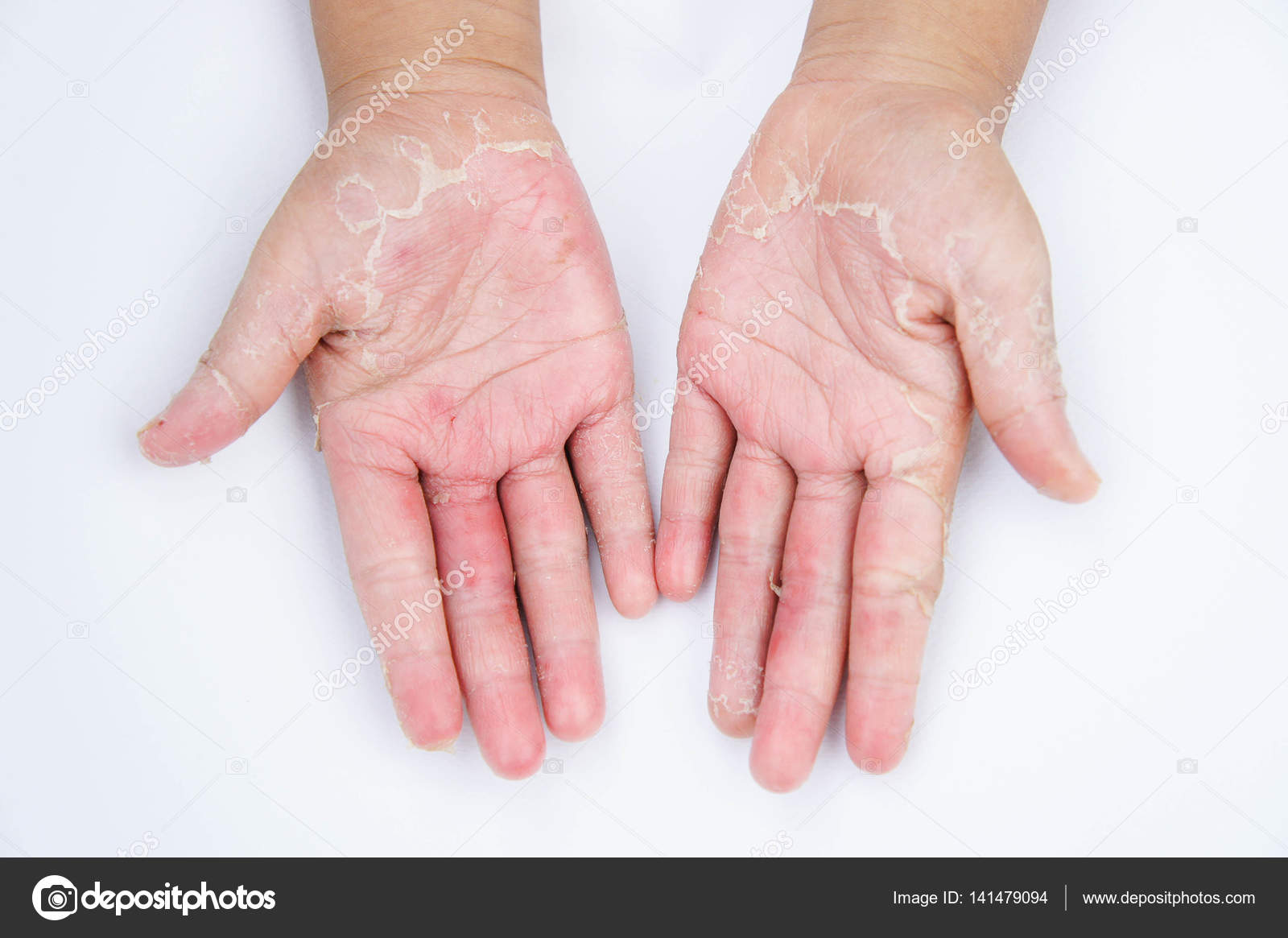 Dry hands, peel, Contact dermatitis, fungal infections, Skin inf ...