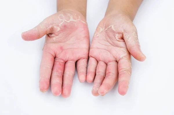 Dry Hands Peel Contact Dermatitis Fungal Infections Skin Infections ...