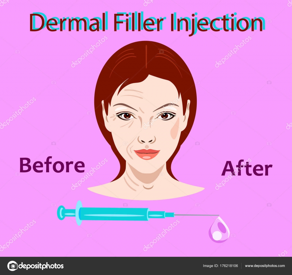 Cosmetic vector illustration. Dermal filler injection. woman facial ...