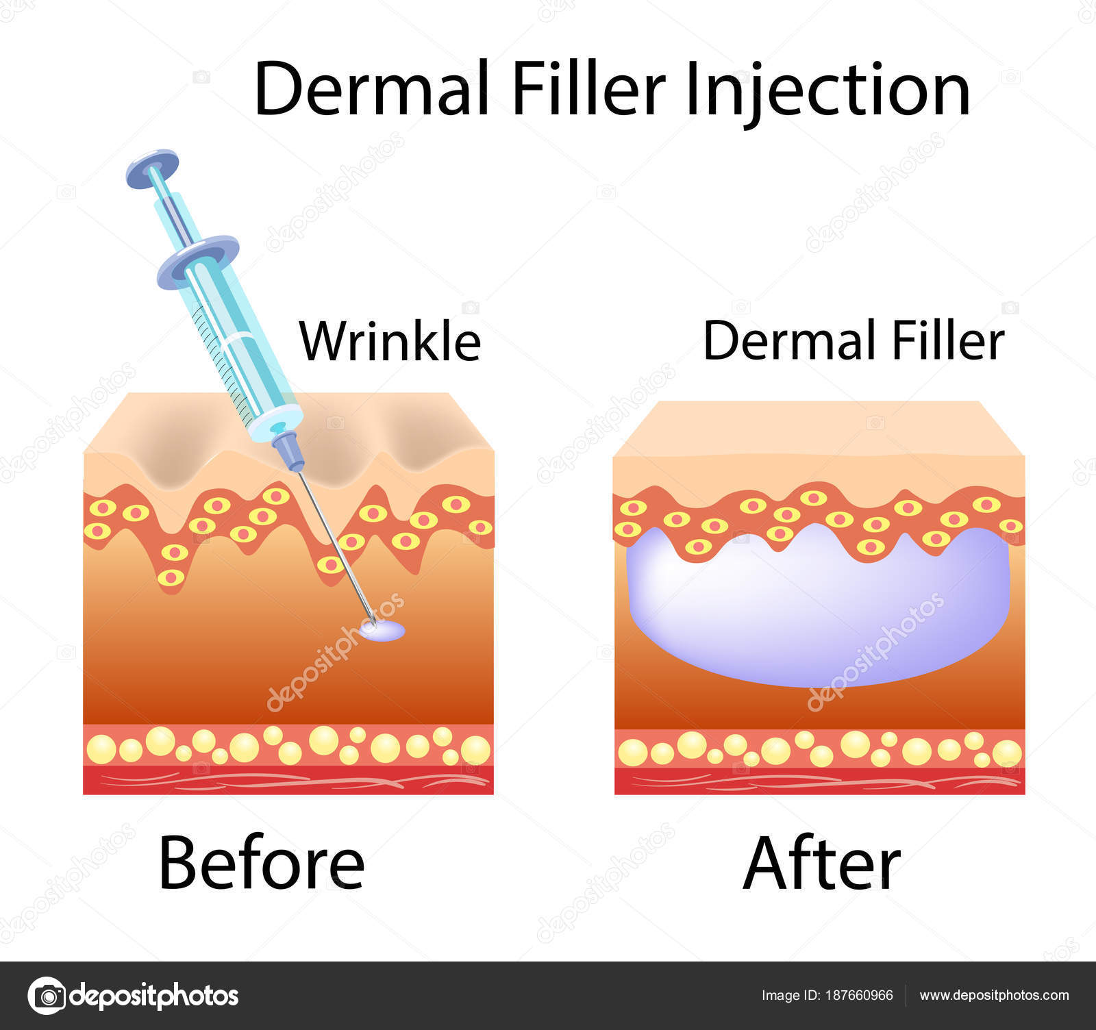Vector illustration with cosmetic filler or Dermal fillers — Stock ...
