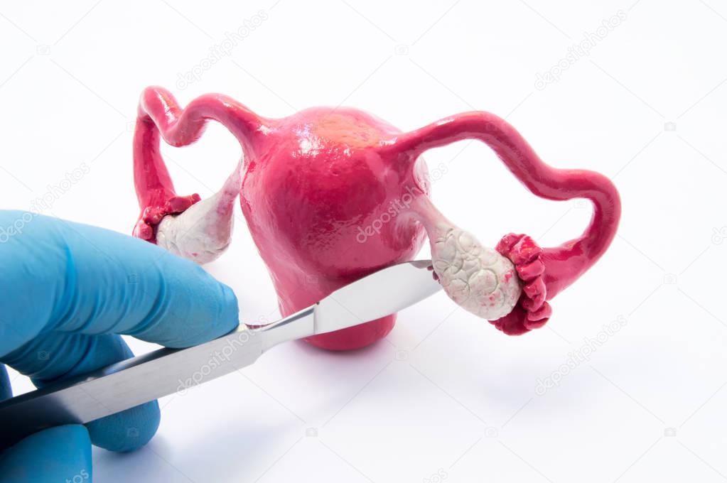 Concept De Lovaire Chirurgie Gynécologique Une Intervention