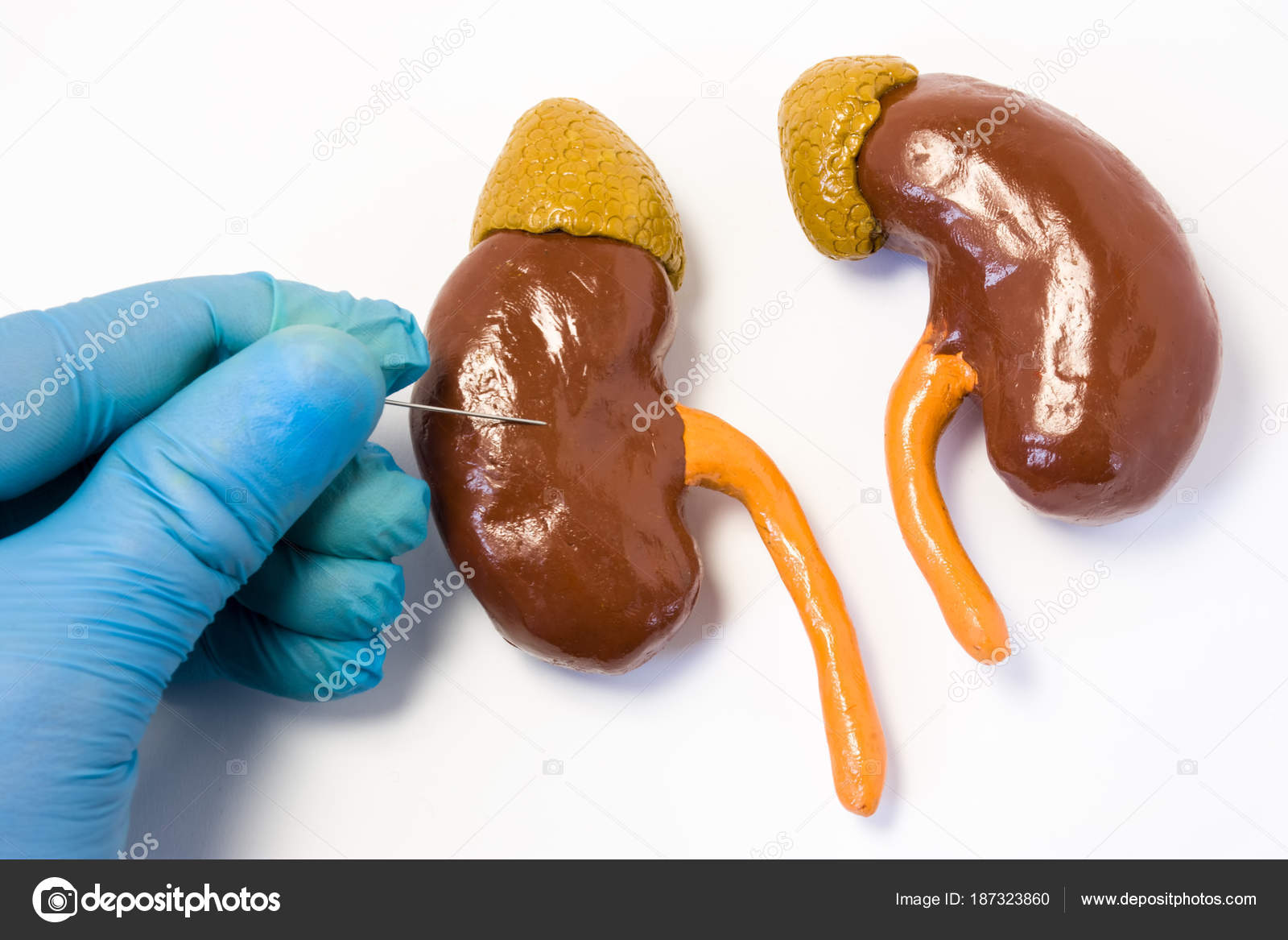 Agulha De Biopsia Renal Fenix Nefrologia Biópsia Renal é Um Exame