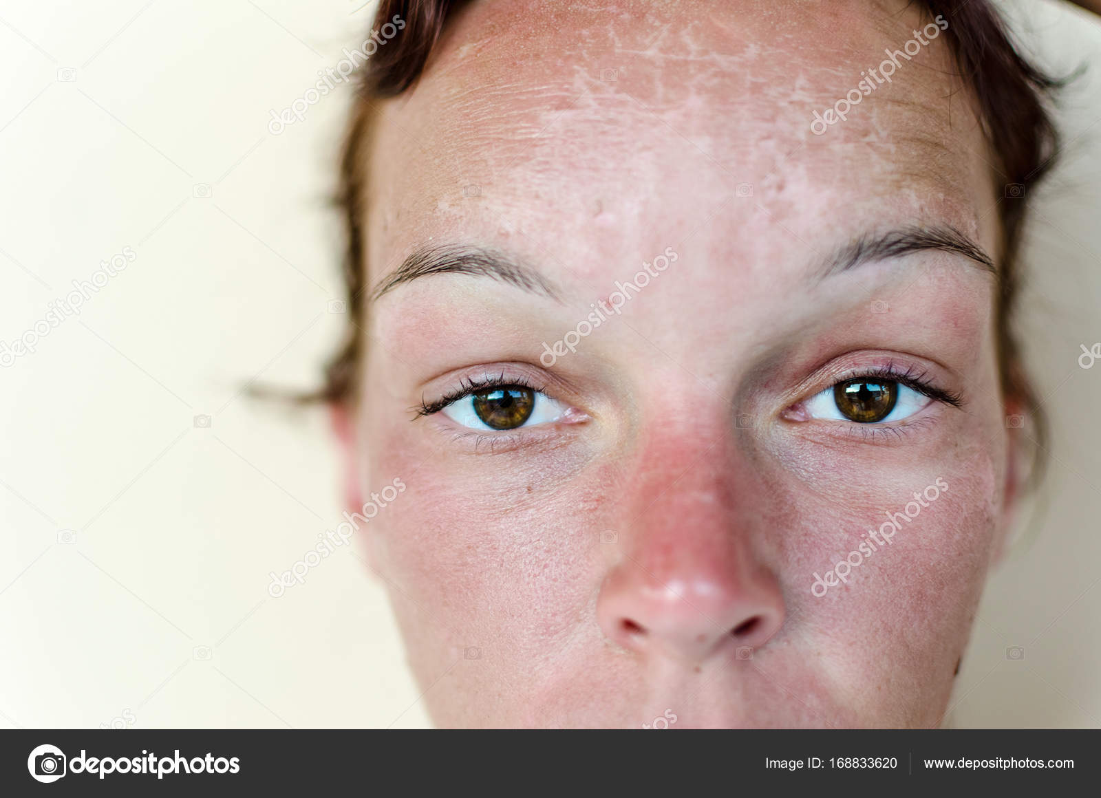 Sunburn and red skin Stock Photo by ©focusandblur 168833620