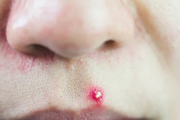 The infected pustulous acne on face, selective focus on acne Stock ...