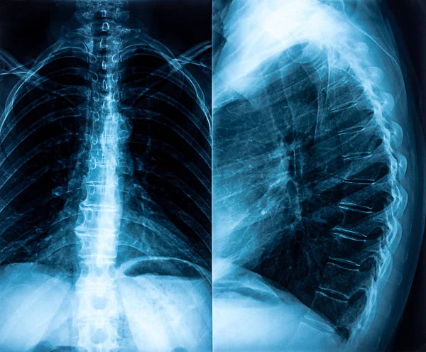 Barium enema of a man demonstrated the normal rectum and cecum — Stock ...