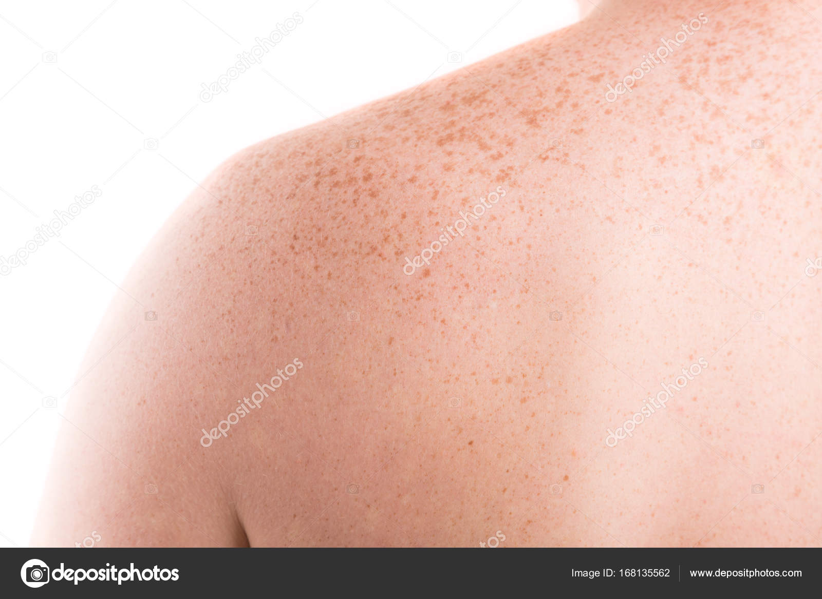 Shoulders skin with pigmentation Stock Photo by ©sun_apple 168135562