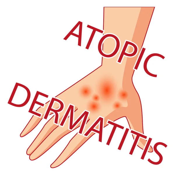ilustraci n de la dermatitis at pica. alergias. dermatolog a. inflamaci n 2024