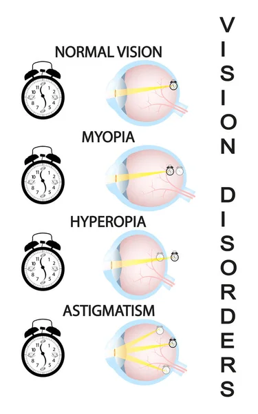 Vision Defects - Myopia, Hyperopia And Astigmatism — Stock Vector ...