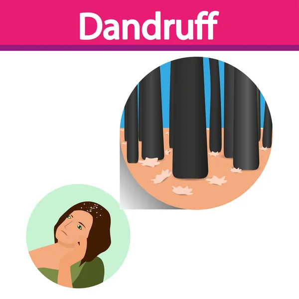 2,647 Dandruff Vector Images | Depositphotos