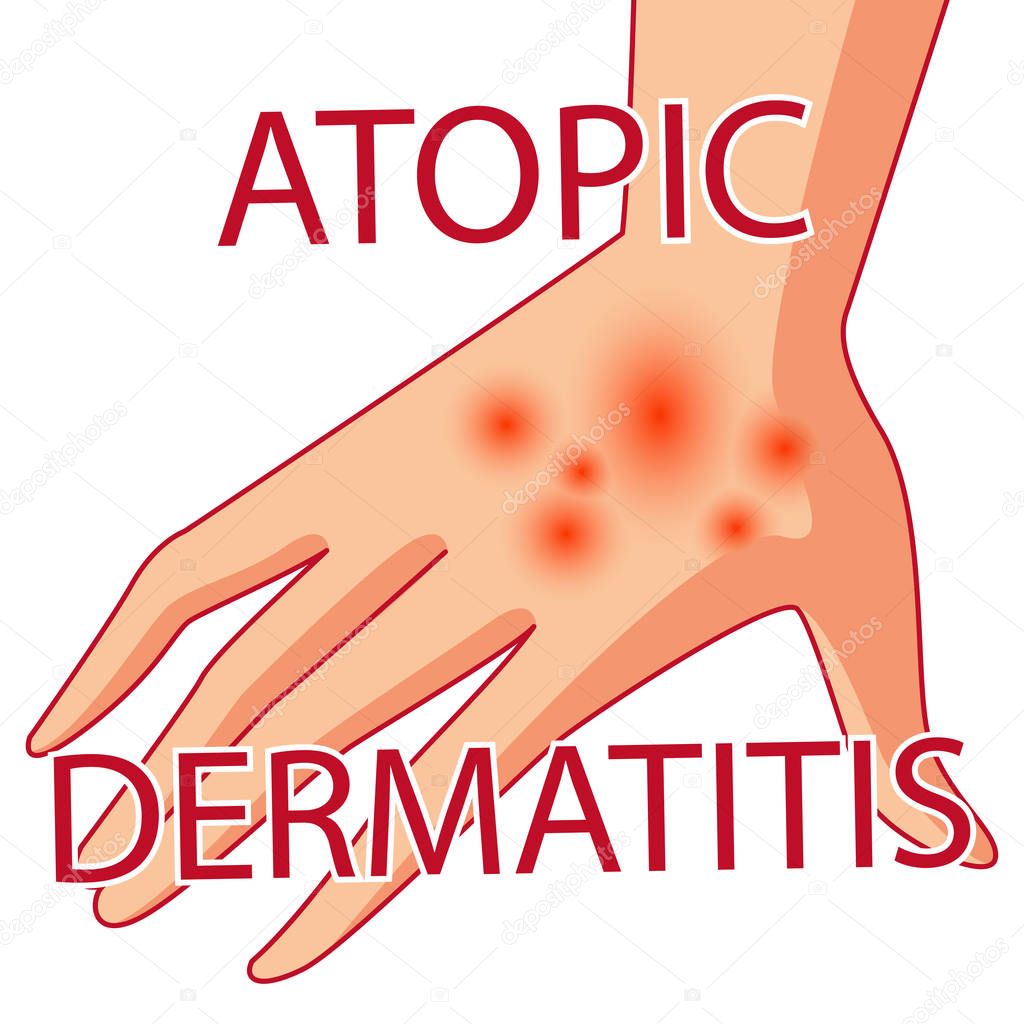 Dermatis atópicos. La persona rasca el brazo en el que está la ...