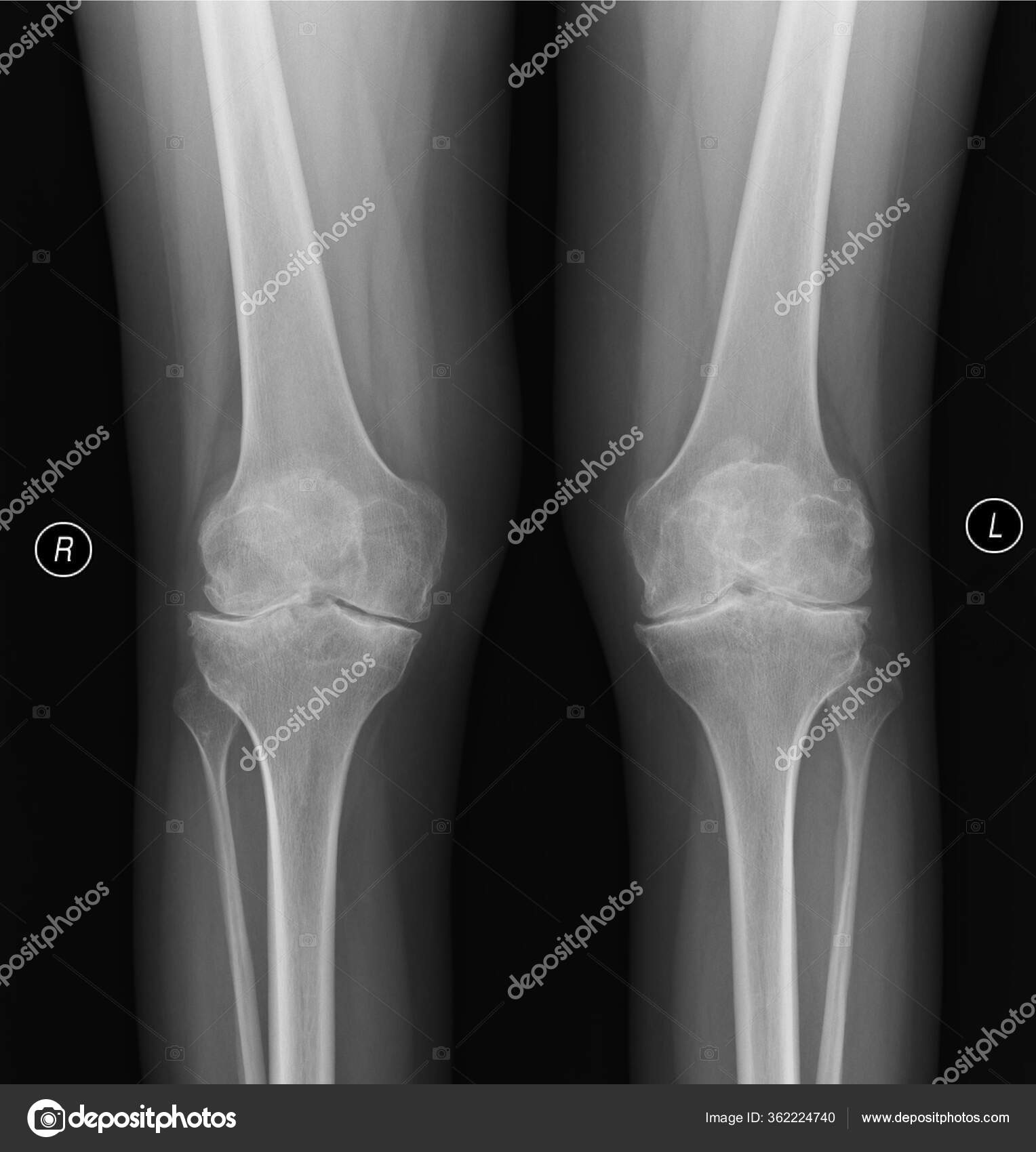 Rheumatoid Arthritis X Ray Knee