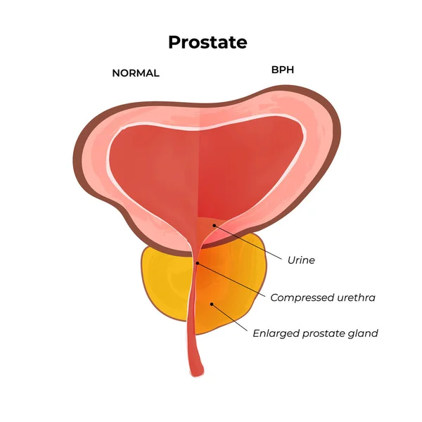 Enlarged prostate Vector Art Stock Images | Depositphotos