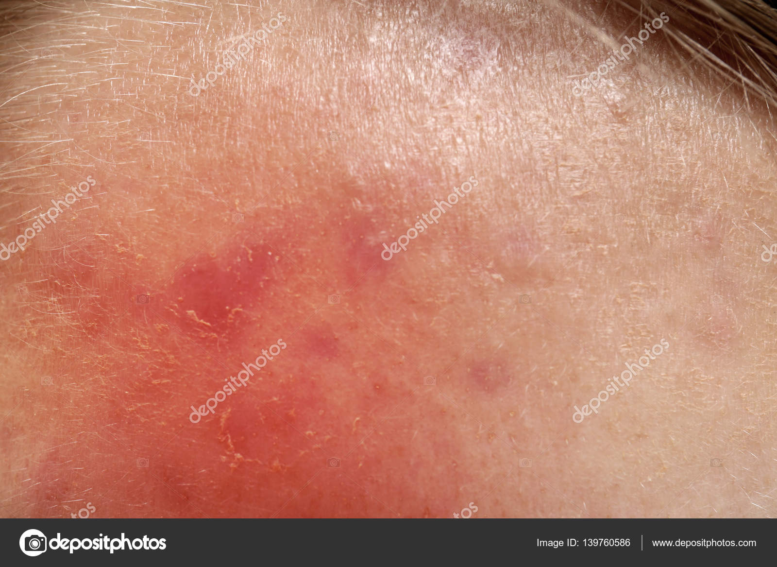 Acne treatment concept. Skin irritation, closeup Stock Photo by ...
