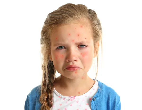 Chicken pox Stock Photos, Royalty Free Chicken pox Images | Depositphotos