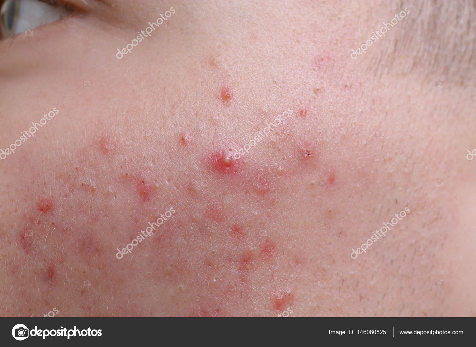 Human Skin Acne Closeup Stock Photo by ©belchonock 146080825