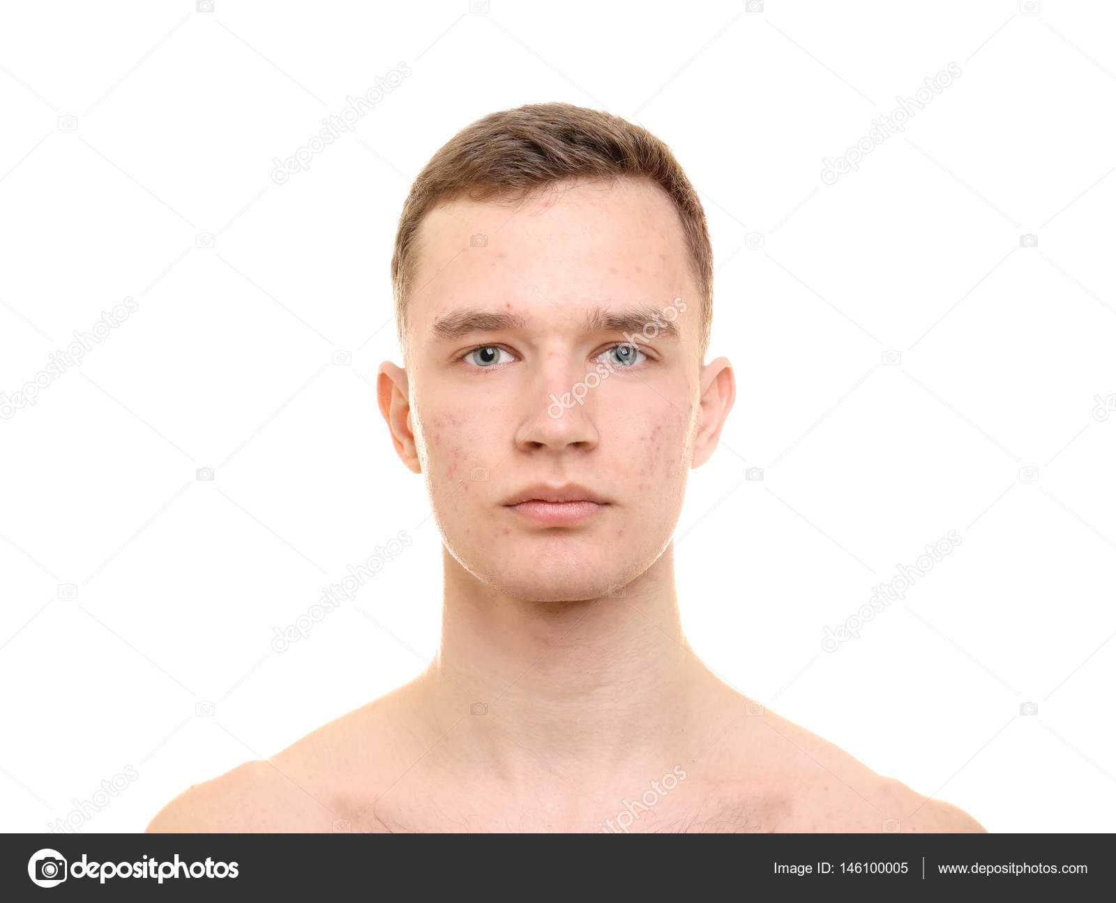 Handsome Young Man Problem Skin White Background Stock Photo by ...