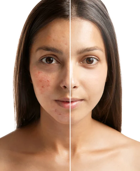 Acne before after Stock Photos, Royalty Free Acne before after Images | Depositphotos