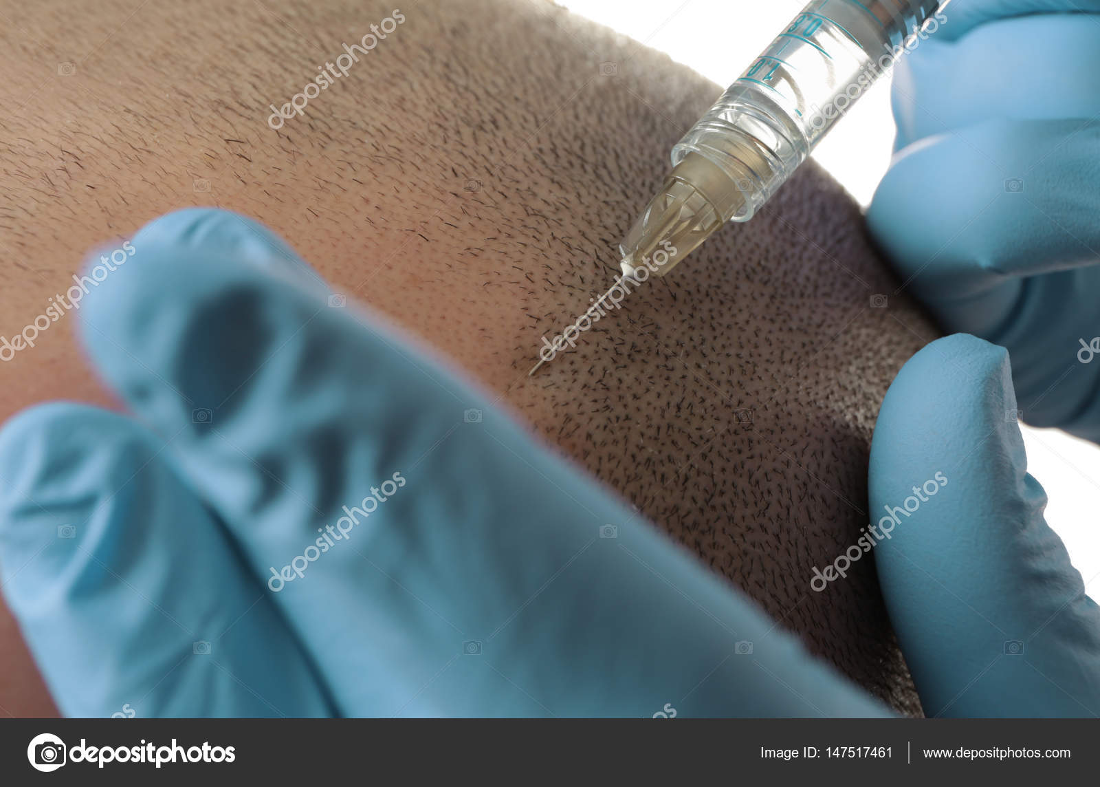 Man receiving stimulating injection for hair growth, closeup Stock ...
