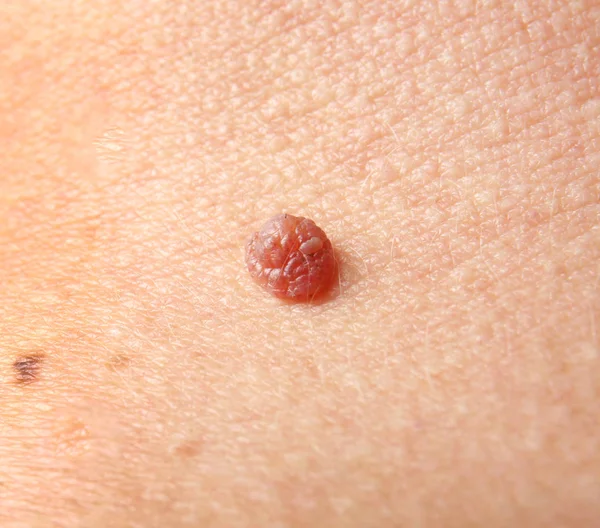 Angioma images libres de droit, photos de Angioma | Depositphotos