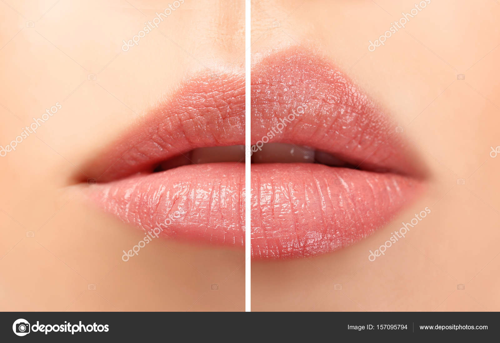 Labios femeninos antes y después del procedimiento de aumento . — Foto ...
