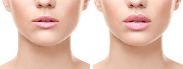 Labios antes despues Stock Photos, Royalty Free Labios antes despues ...