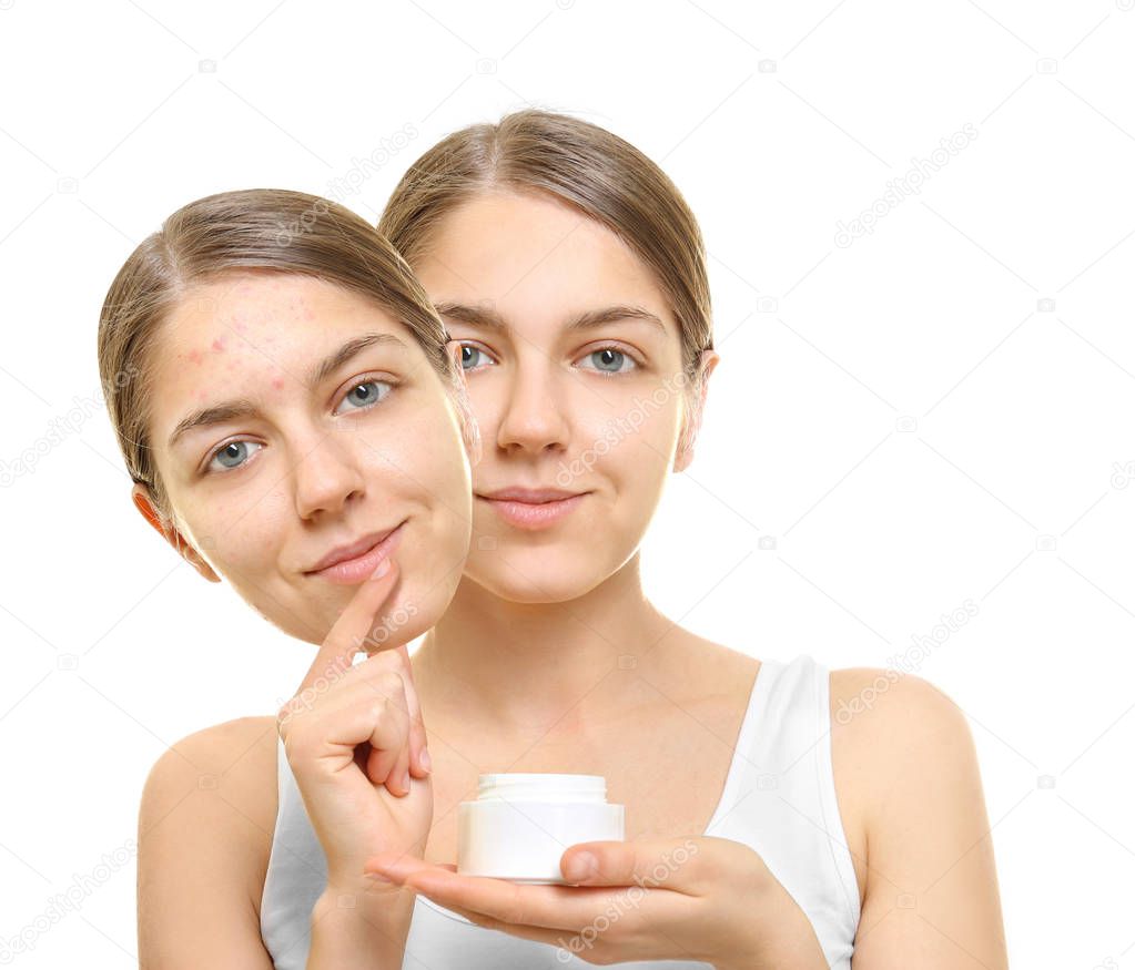 Mujer joven antes y después del tratamiento del acné sobre fondo blanco ...