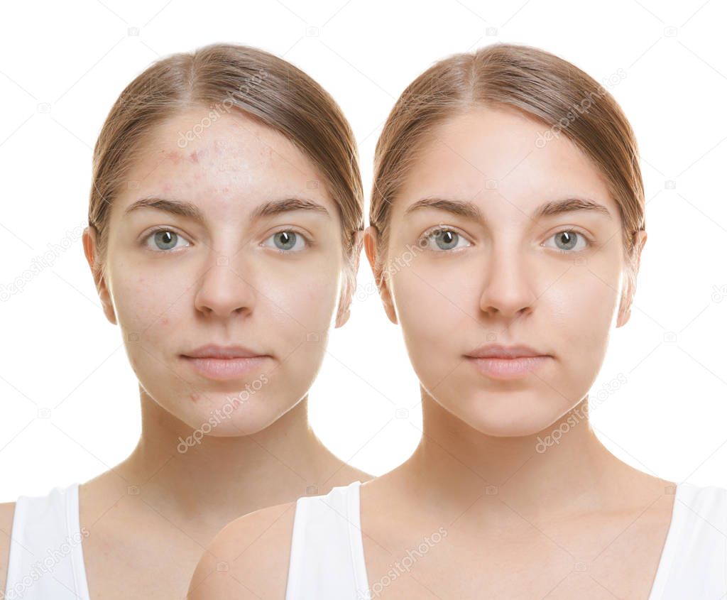 Mujer joven antes y después del tratamiento del acné sobre fondo blanco ...