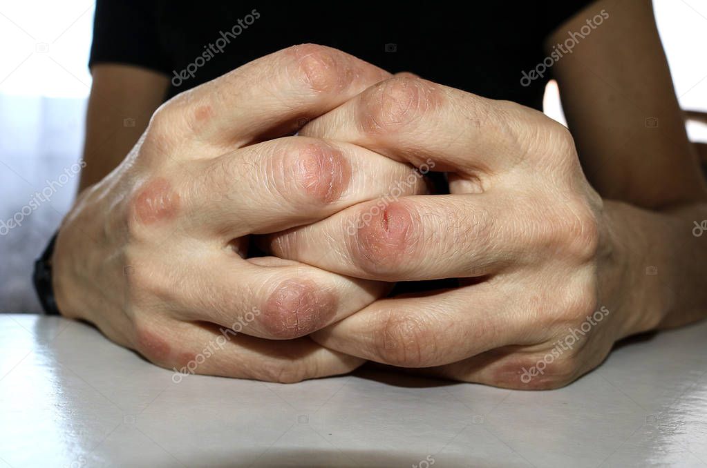 Manos juntas, afectadas por la psoriasis. Enrojecimiento y manchas ...