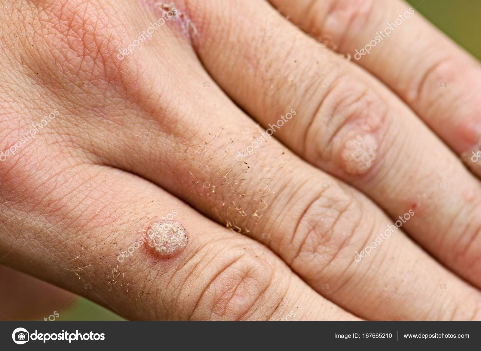 What Does A Wart Look Like On Fingers In Indonesia - Infoupdate.org