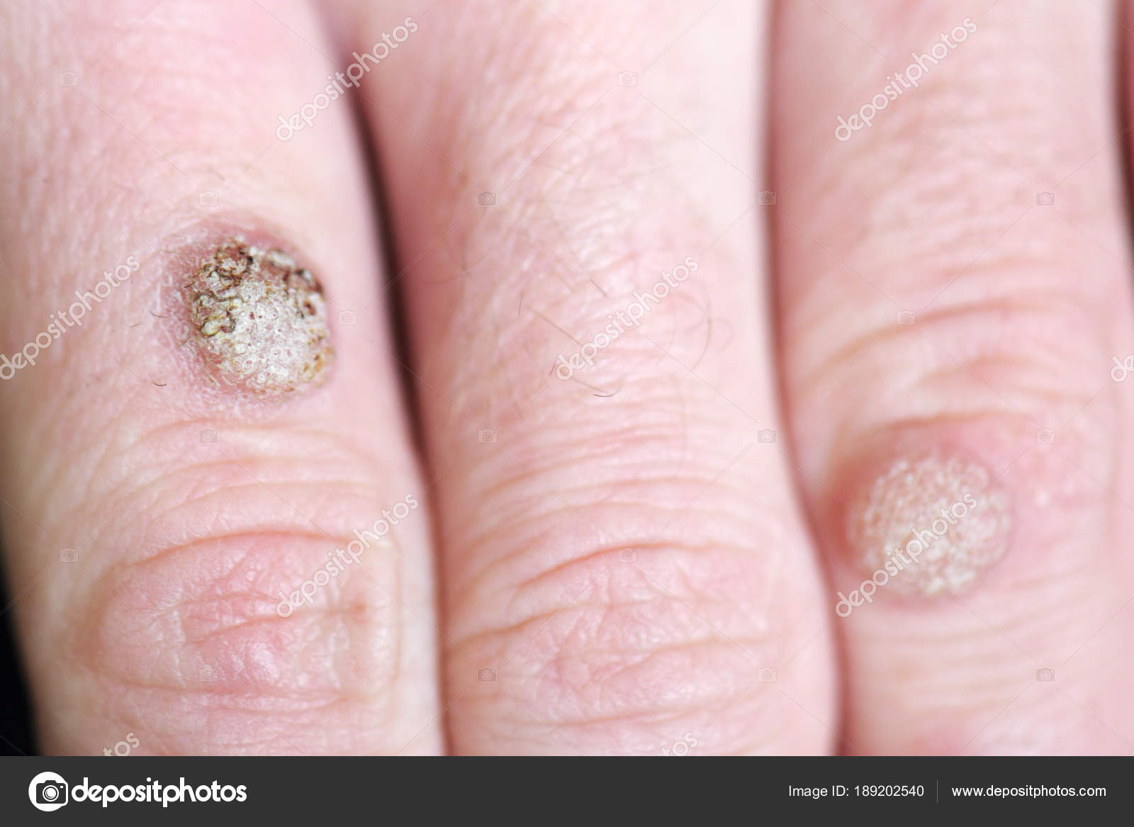 Verruca Sul Dito Verruca Sul Dito Della Mano Foto Stock Alamy