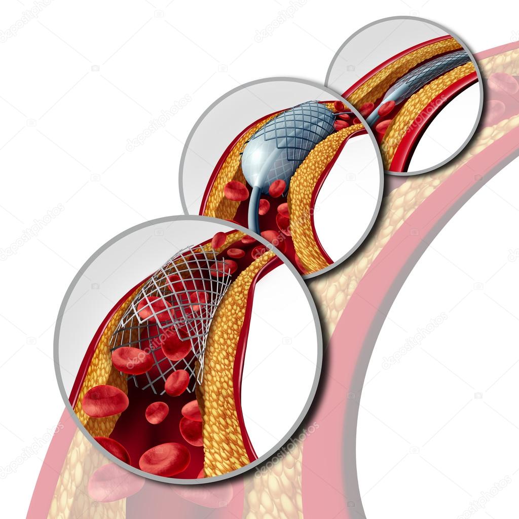 Picture: a heart stent | Stent Coronary Medical Concept — Stock Photo ...