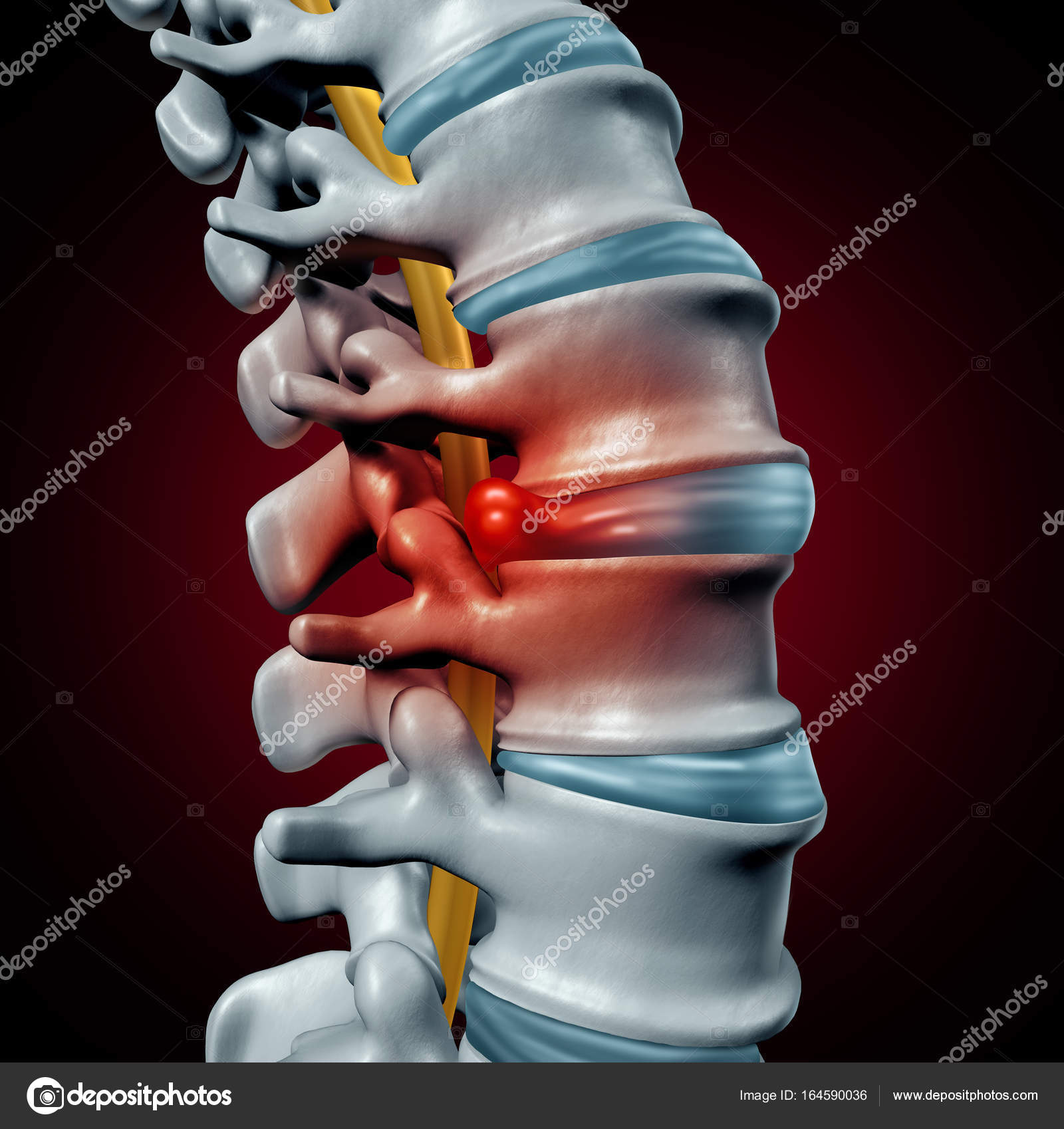 Human Herniated Disk Stock Photo by ©lightsource 164590036