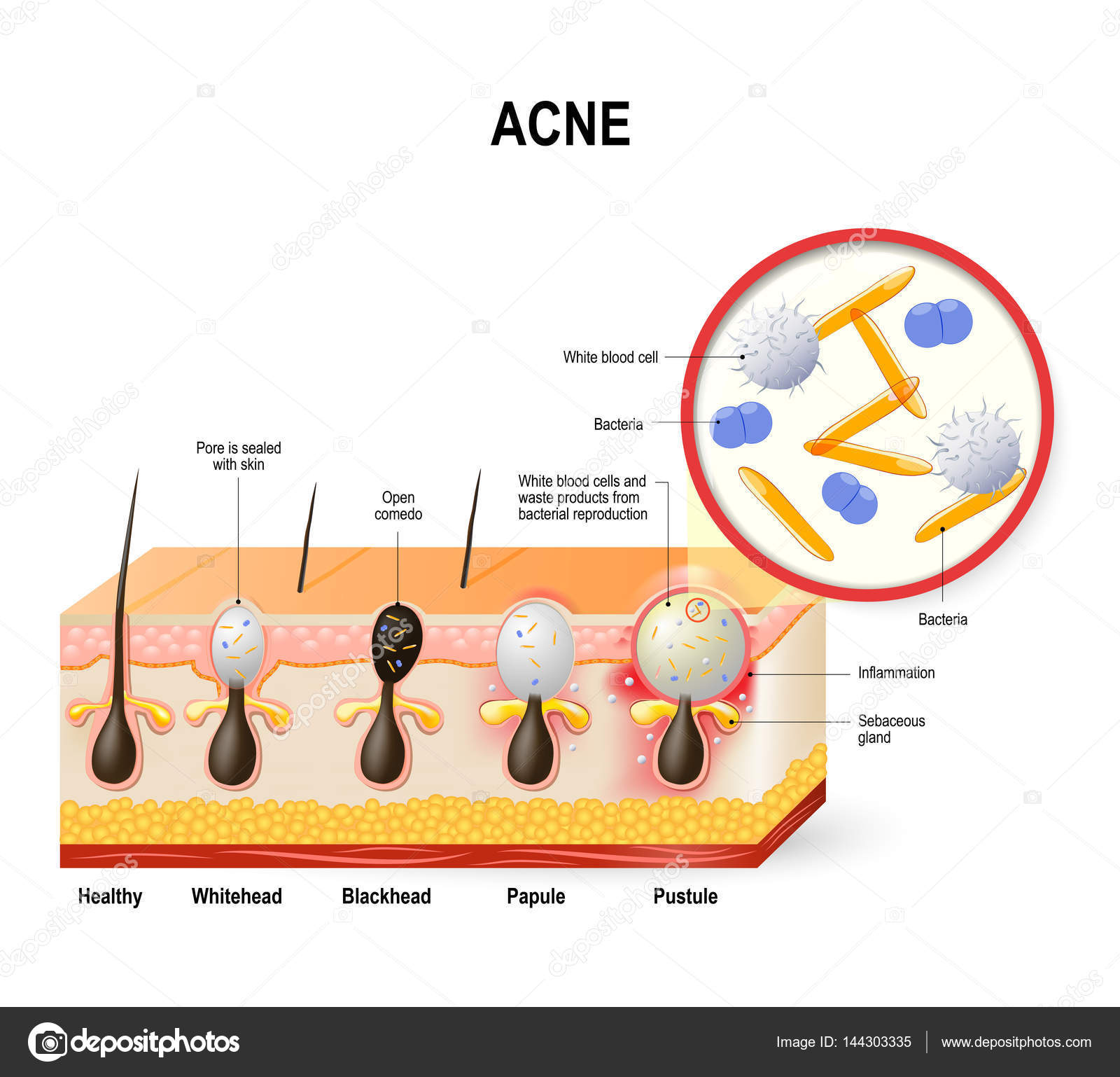 Acne vulgaris or pimple. Stock Vector Image by ©edesignua #144303335