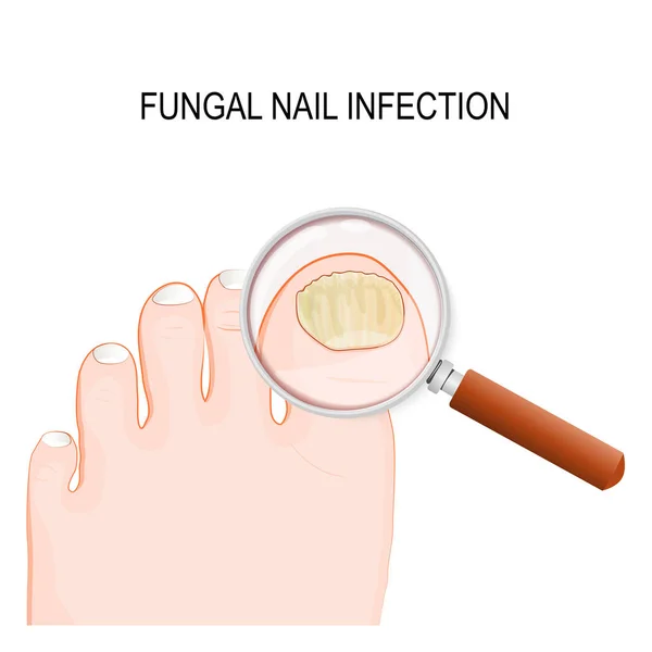 Fungal infection Stock Vectors, Royalty Free Fungal infection ...