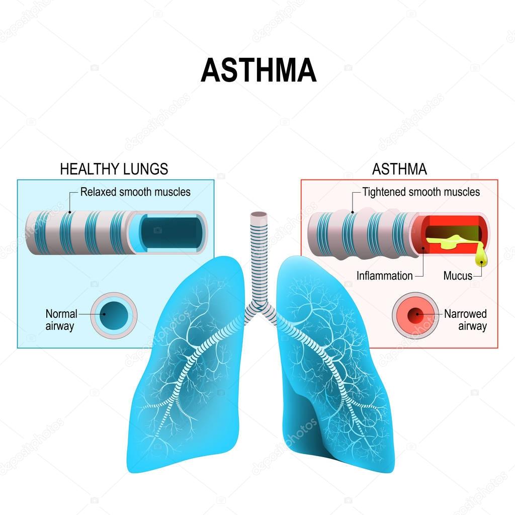 Asma. Pulmones y bronquios humanos 2023