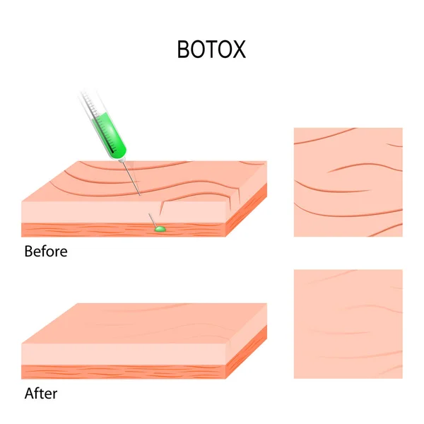 100,000 Botox treatment Vector Images | Depositphotos