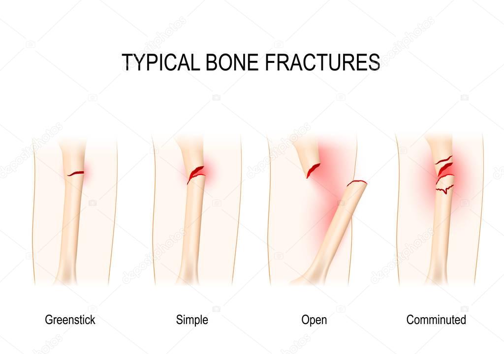 Typical bone fractures: Greenstick, Simple, Open, Comminuted. Vector ... Typical bone fractures: Greenstick, Simple, Open, Comminuted. Vector ...