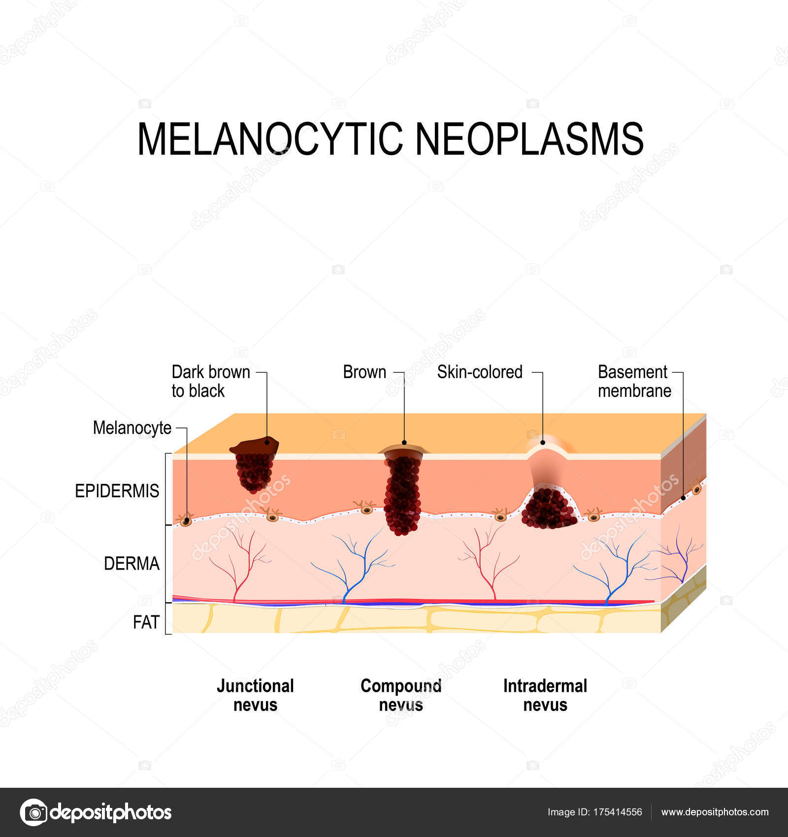 Melanocytic nevus — Stock Vector © edesignua #175414556