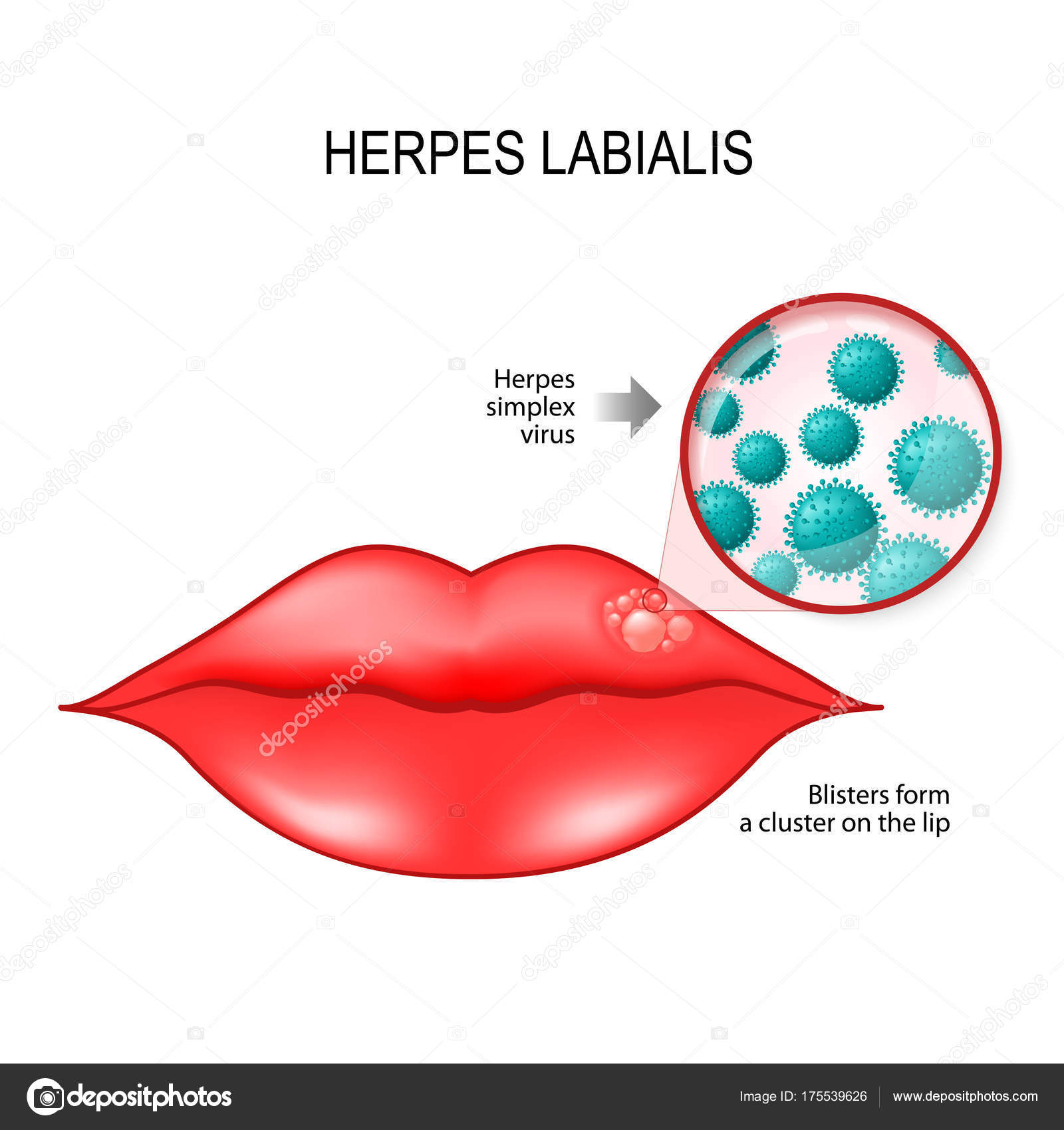 Herpes labial en los labios Vector de stock #175539626 de ©edesignua