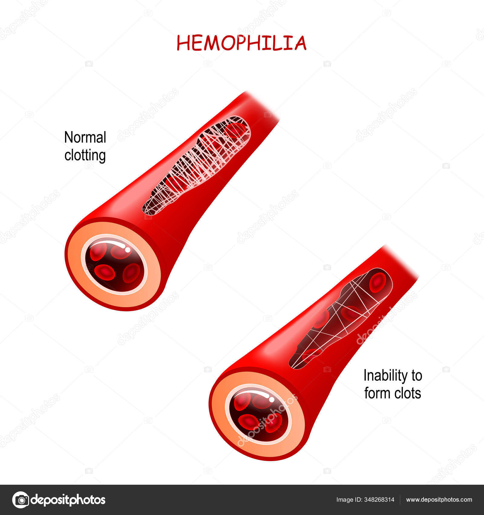 Haemophilia Hemophilia Healthy Blood Vessel Bleeding Blood Vessel Coagulation Disorder Stock ...
