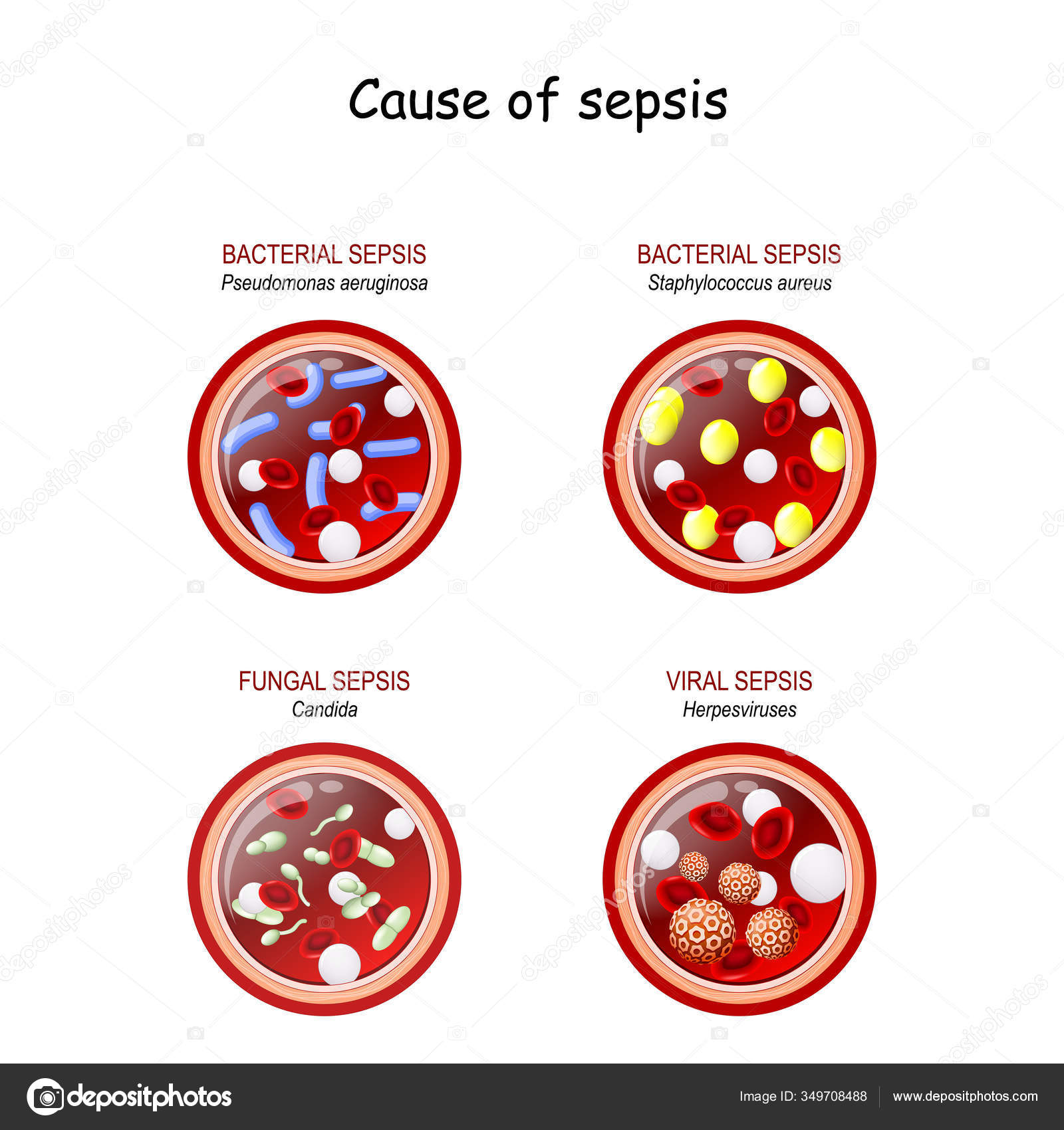 Oorzaak Van Sepsis Schimmel Candida Viraal Herpes Bacterieel ...
