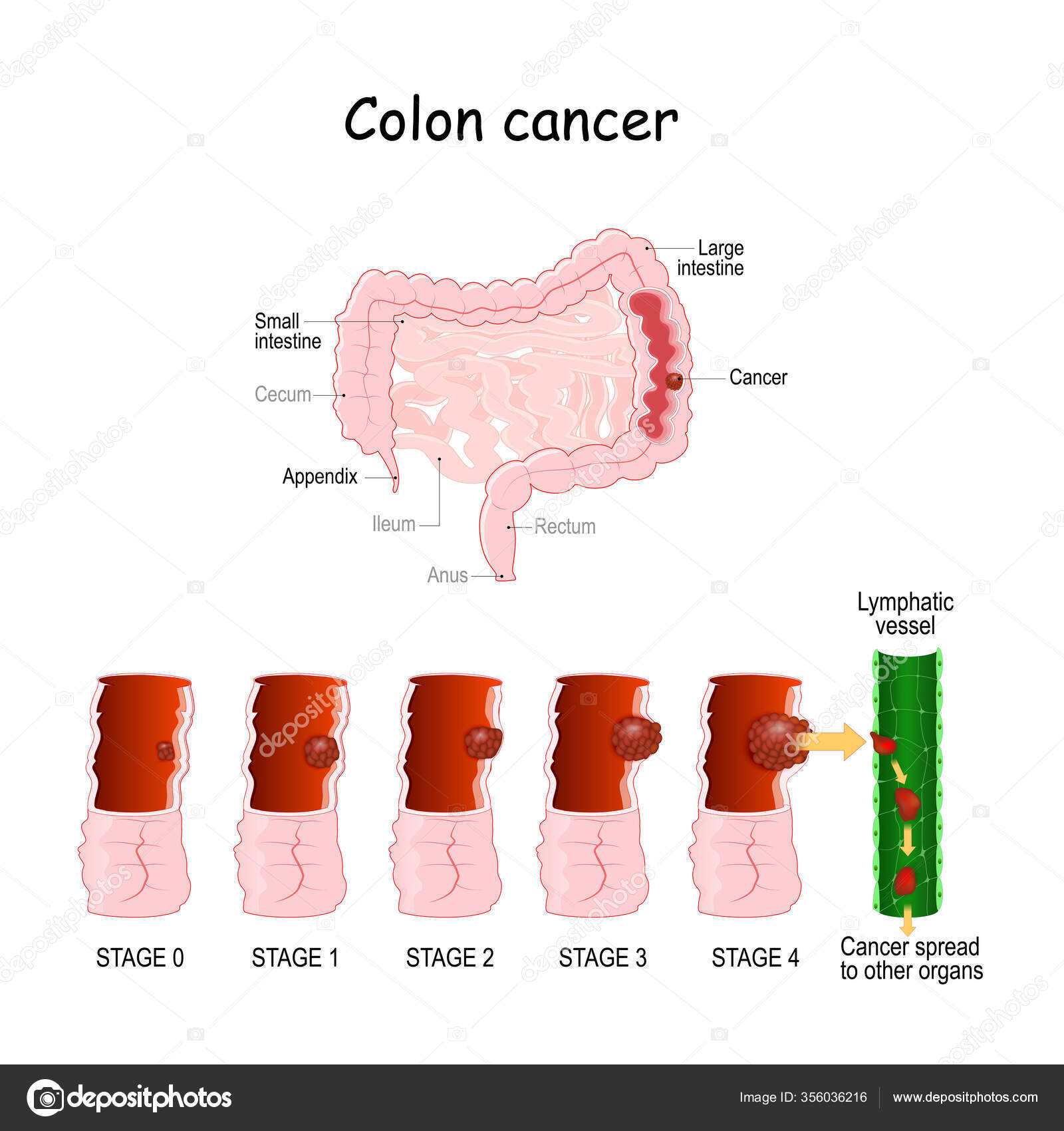 Cáncer Colon Oncología Colorrectal Desarrollo Tumor Maligno Estadios ...