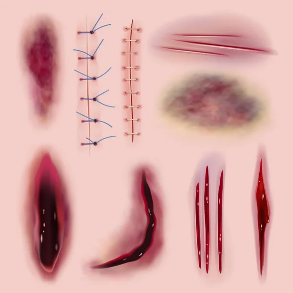 Stitching wound, Royalty-free Stitching wound Vector Images & Drawings ...