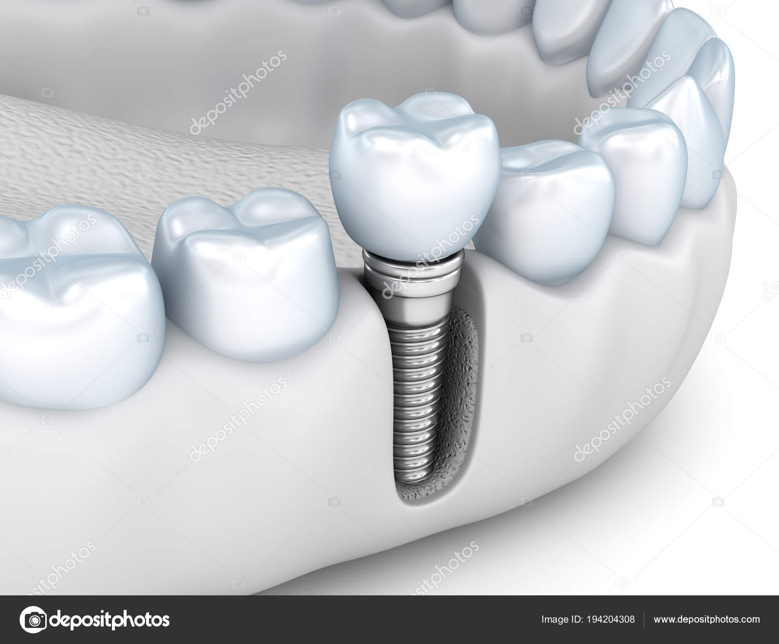 Tooth Implant Instalation Process Medically Accurate Illustration White ...