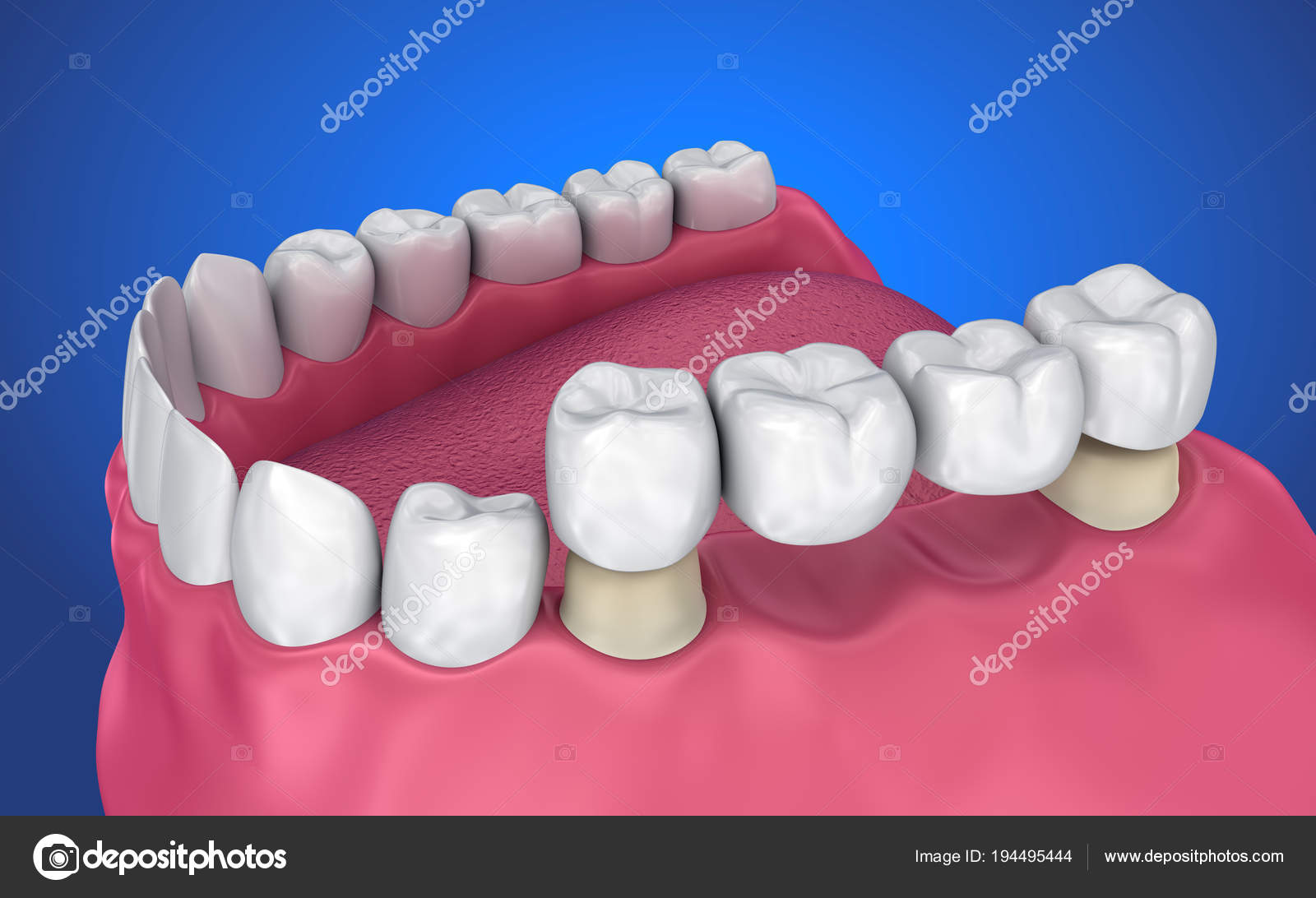 Tooth Supported Fixed Bridge Medically Accurate Illustration — Stock ...