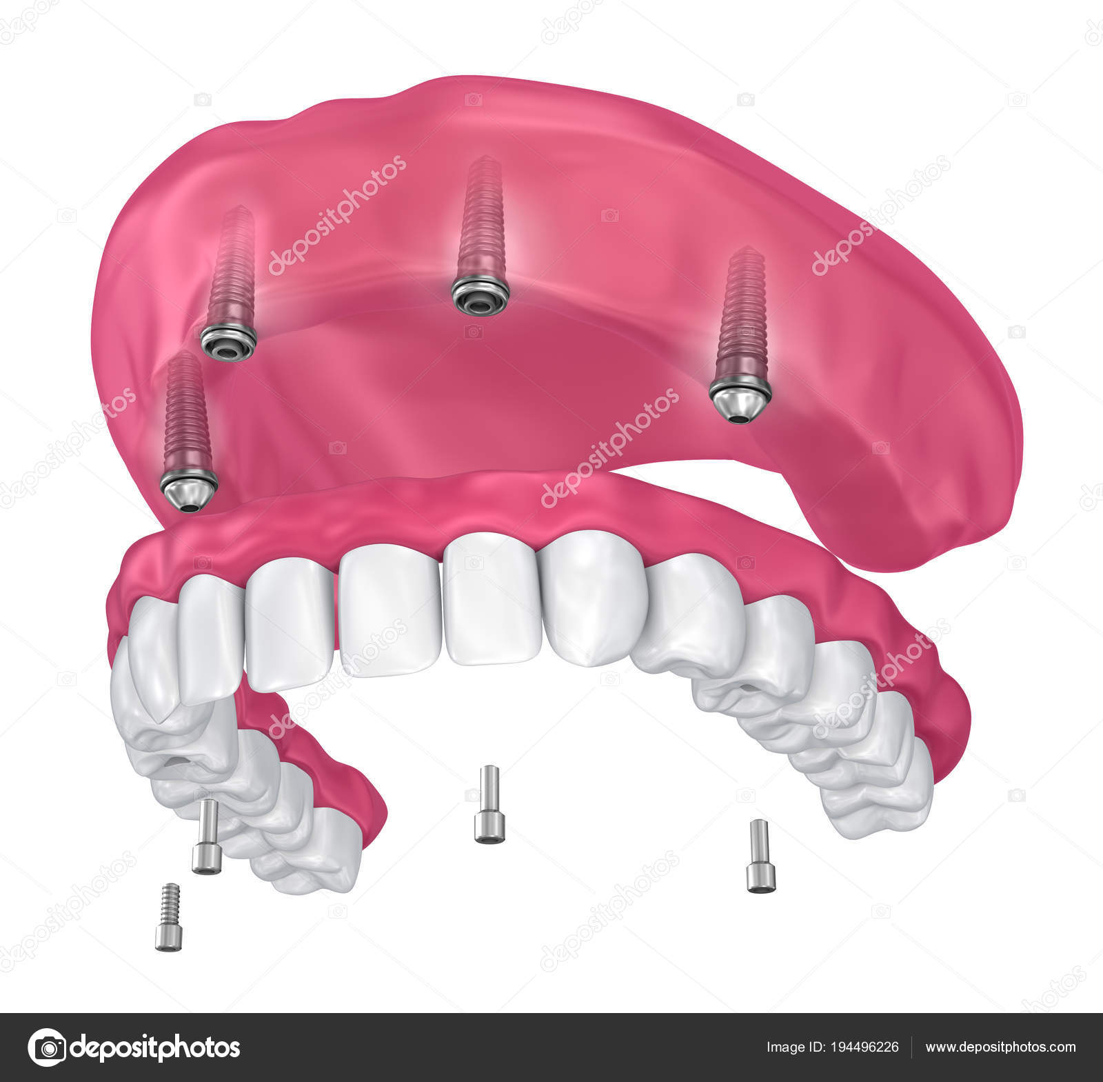 Overdenture Seated Implants Attachments Illustration Stock Photo by ...