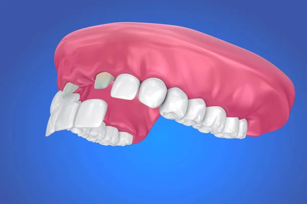 Tooth Supported Fixed Bridge Medically Accurate Illustration Stock ...