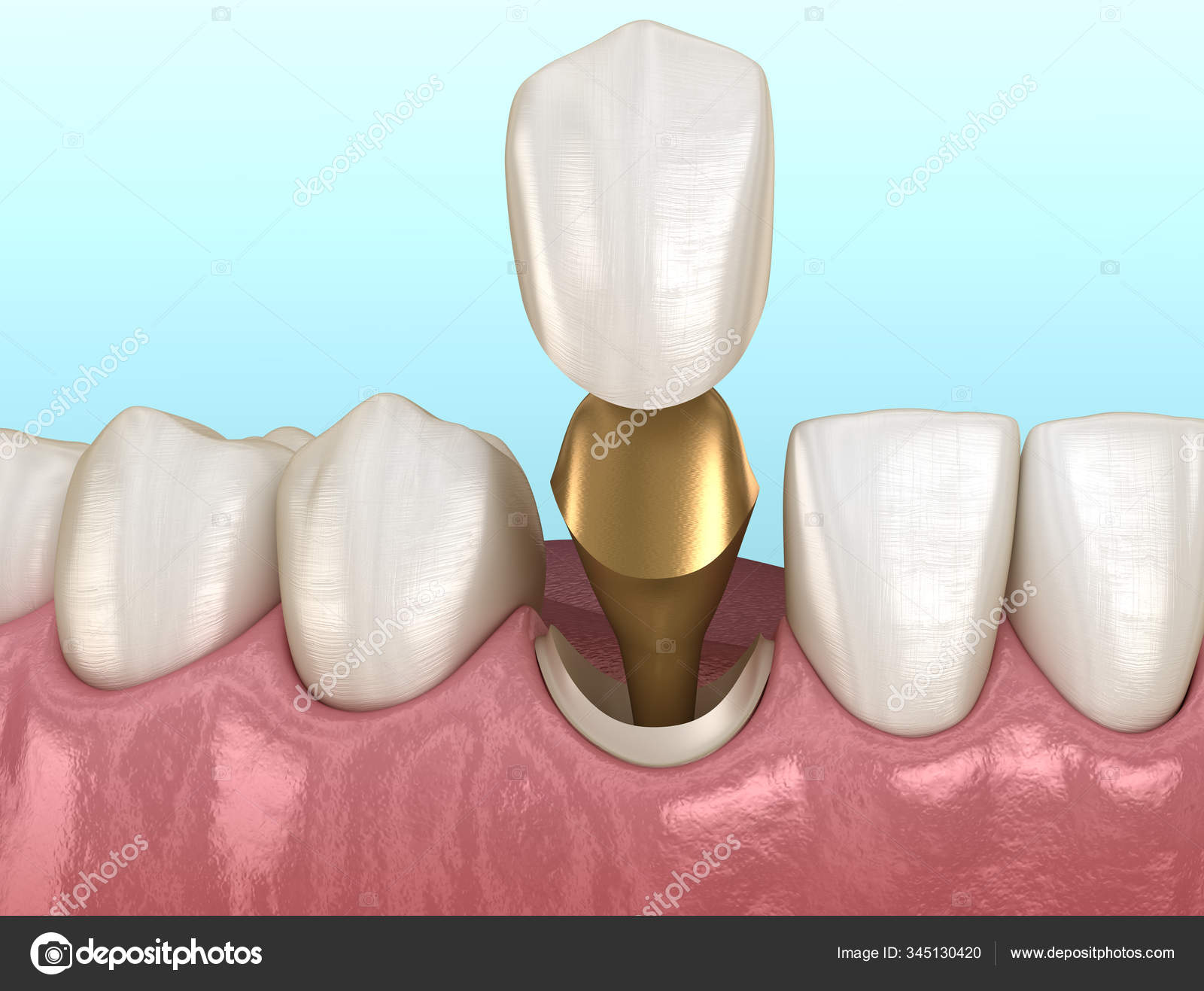 Golden Stump Pin Tab Canaine Tooth Medically Accurate Dental ...